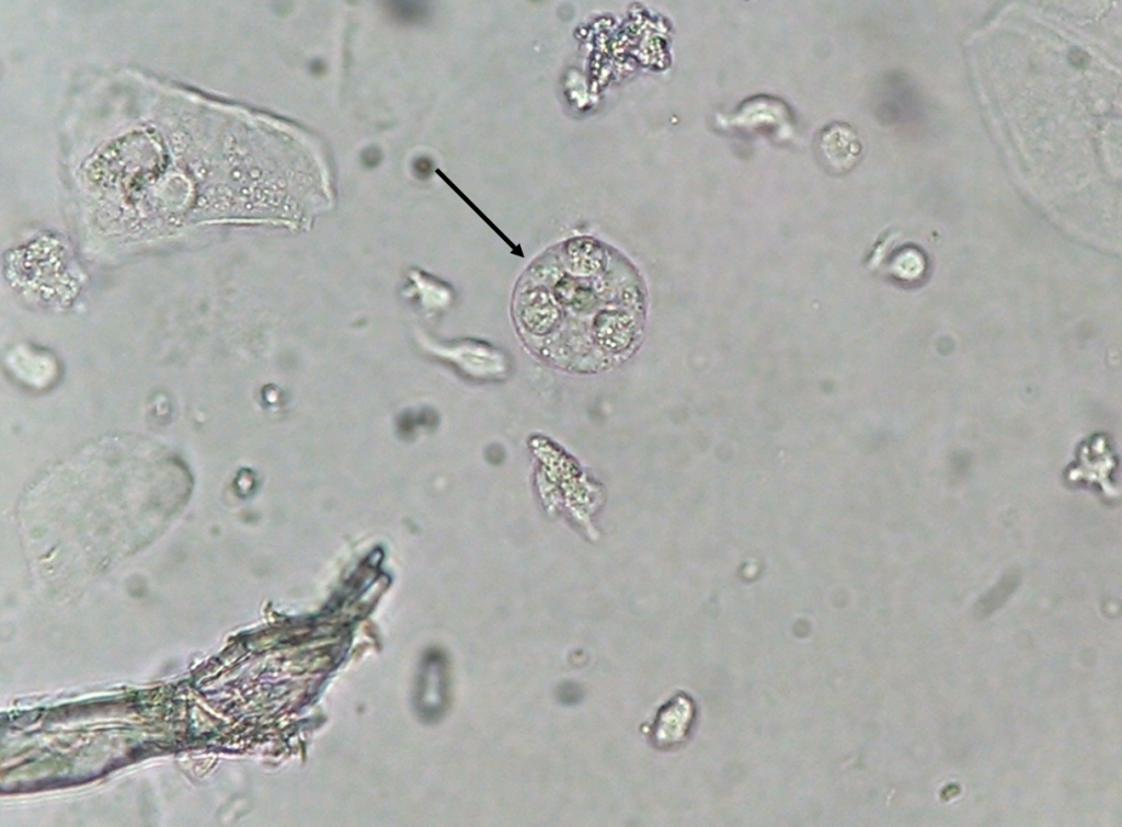 Urine Sediment of the Month: Identifying Phagocytosed Particles - Renal ...