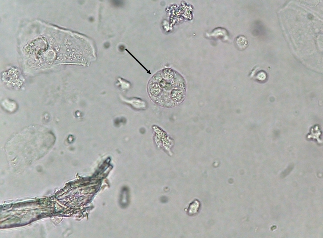 Urine Sediment of the Month: Identifying Phagocytosed Particles - Renal ...
