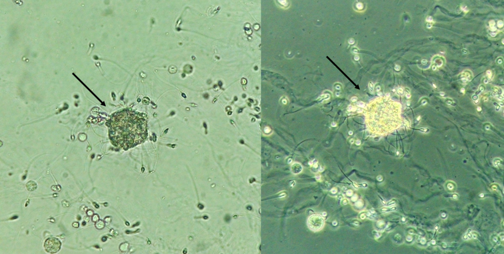 Urine Sediment of the Month: Identifying Phagocytosed Particles - Renal ...