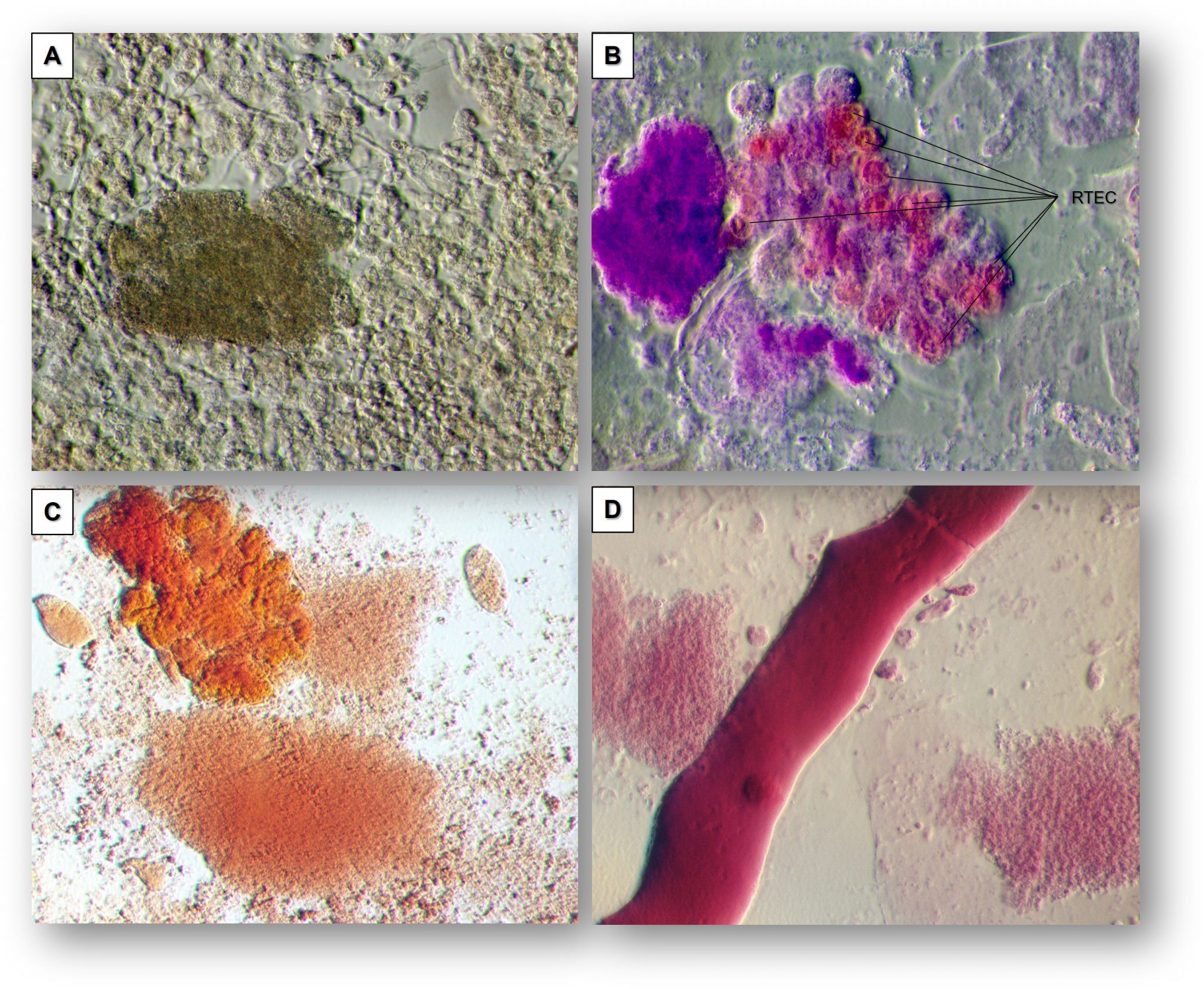 Urine Sediment of the Month Archives - Renal Fellow Network