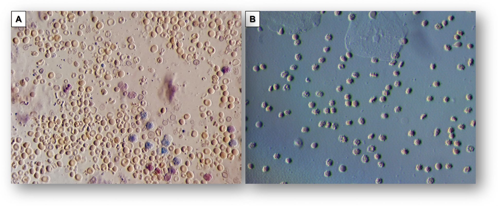 Urine Sediment of the Month: Oblique Illumination in Microscopy - Renal ...