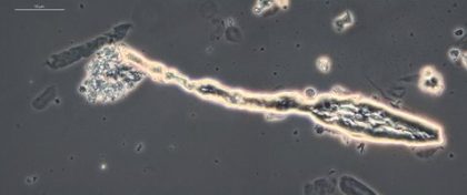 Urine Sediment of the Month: The Thin Waxy Cast - Renal Fellow Network
