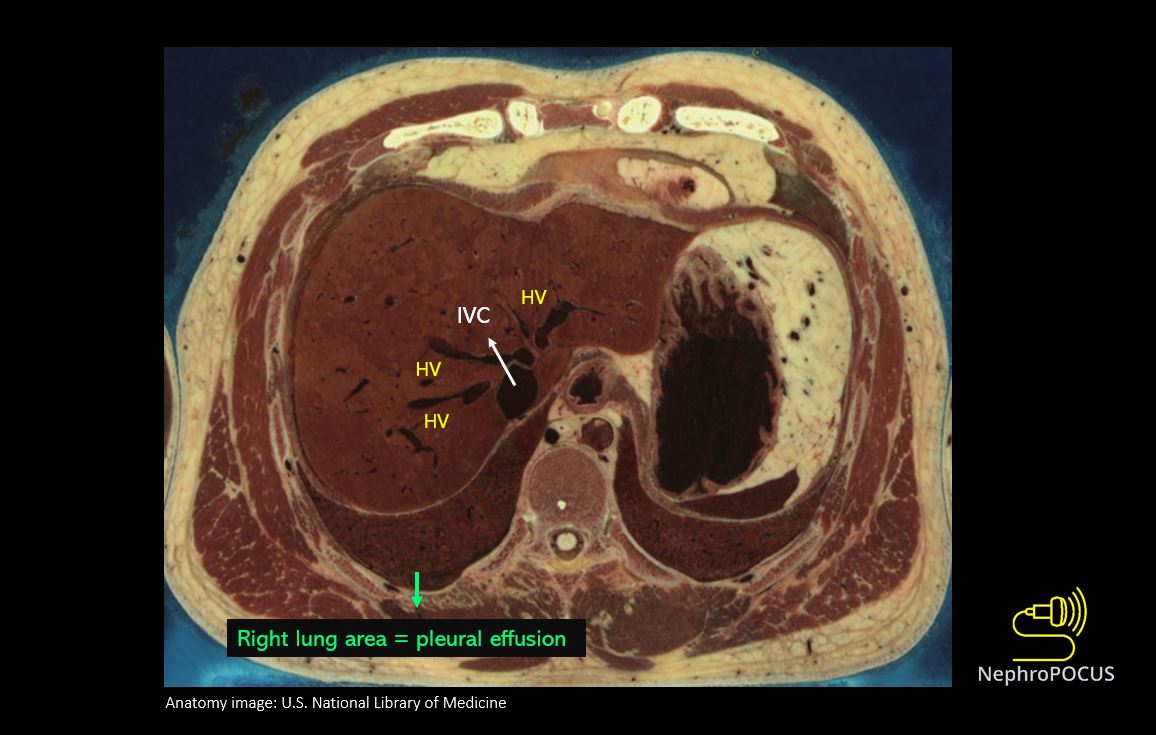 Identification of various effusions on standard echocardiographic views ...