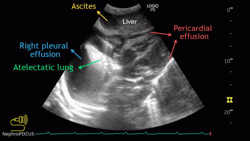 Identification of various effusions on standard echocardiographic views ...