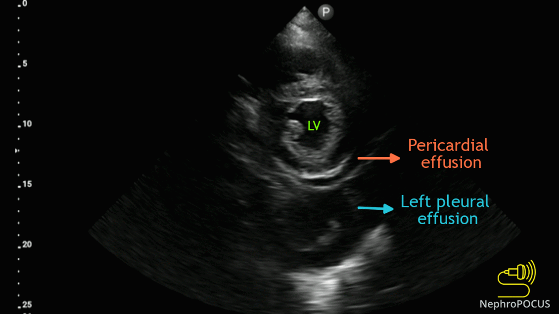 Identification of various effusions on standard echocardiographic views ...