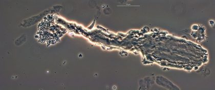 Urine Sediment of the Month: The Thin Waxy Cast - Renal Fellow Network
