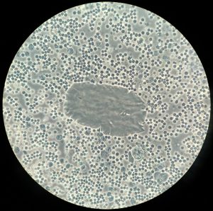 Urine Sediment of the Month: The Thin Waxy Cast - Renal Fellow Network
