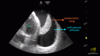 Identification of various effusions on standard echocardiographic views ...