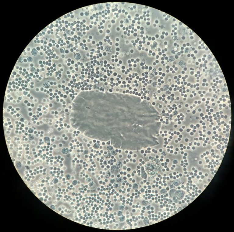 Urine Sediment of the Month: The Thin Waxy Cast - Renal Fellow Network