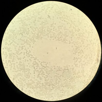 Urine Sediment of the Month: The Thin Waxy Cast - Renal Fellow Network