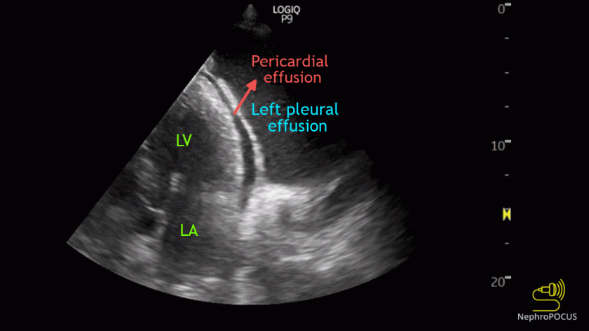 Identification of various effusions on standard echocardiographic views ...