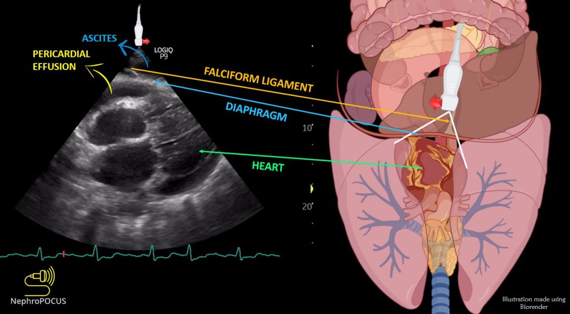 Identification of various effusions on standard echocardiographic views ...
