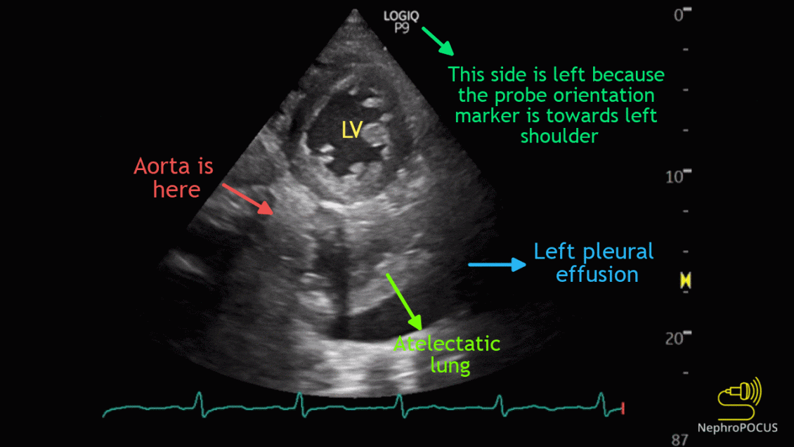 Identification of various effusions on standard echocardiographic views ...