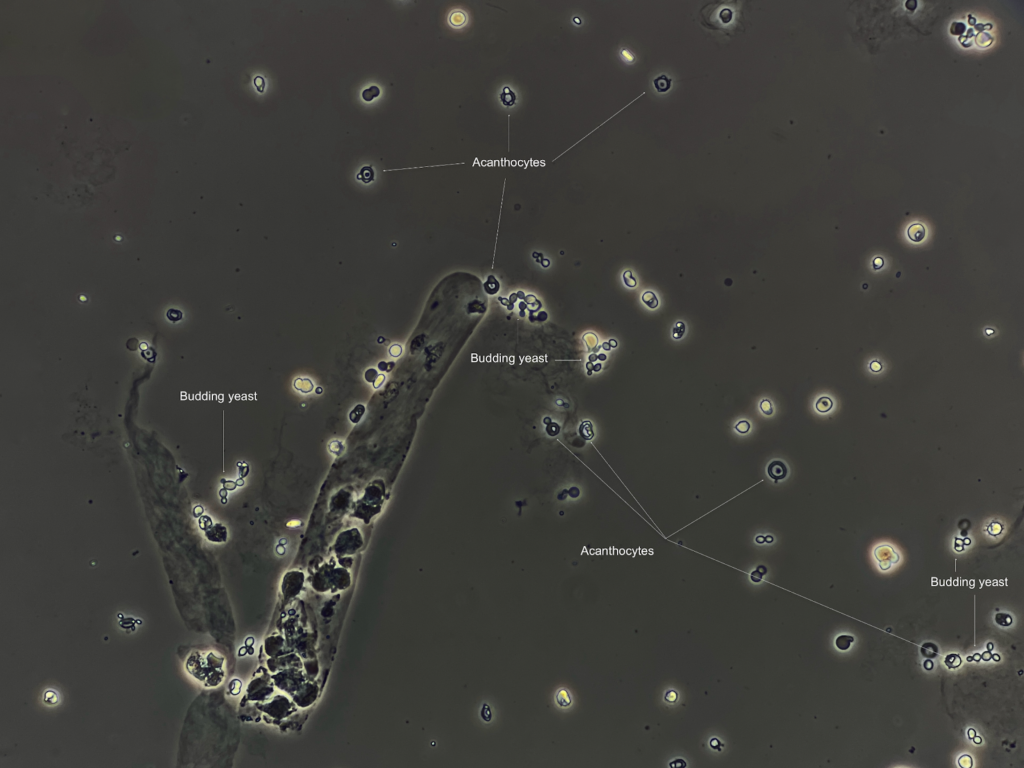 Urine Sediment of the Month: RBC "Lookalikes" - Renal Fellow Network