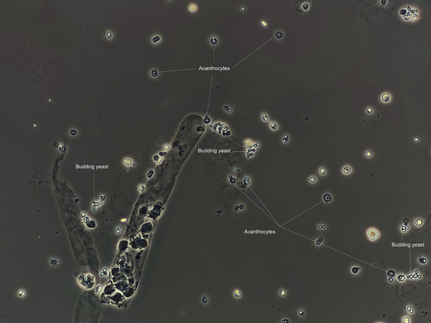 Urine Sediment of the Month Archives - Renal Fellow Network