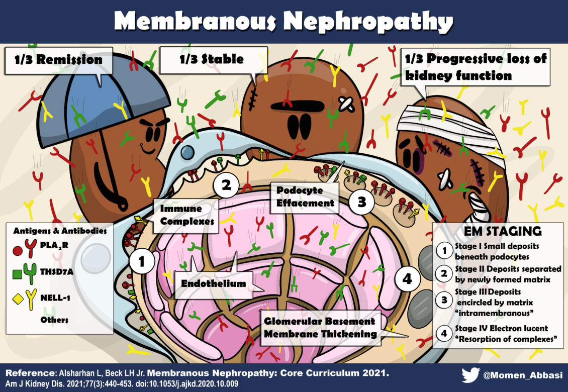 Kidney Comics: Membranous Nephropathy - Renal Fellow Network