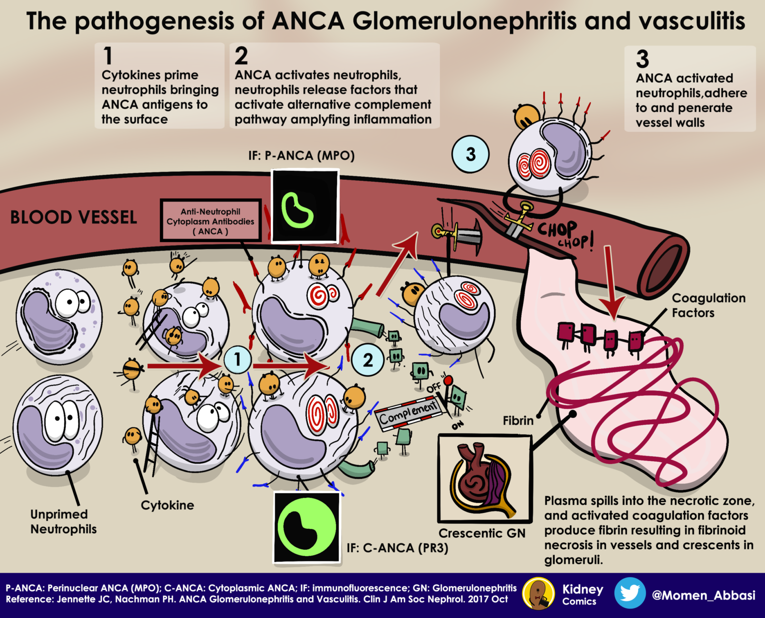 Kidney Comics: The Pathogenesis of ANCA Associated Vasculitis - Renal ...