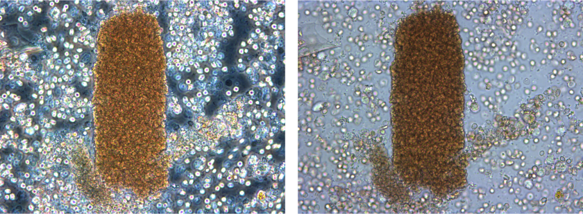AKI in a patient with macroscopic hematuria - Renal Fellow Network
