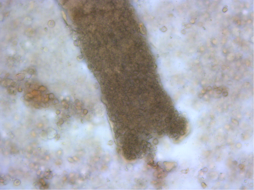 AKI in a patient with macroscopic hematuria - Renal Fellow Network