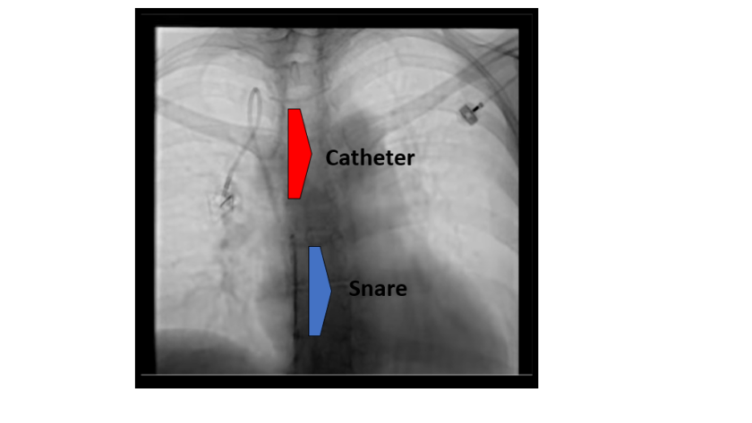 Disrupting Catheter Associated Fibrin Sheath Formation - Renal Fellow ...