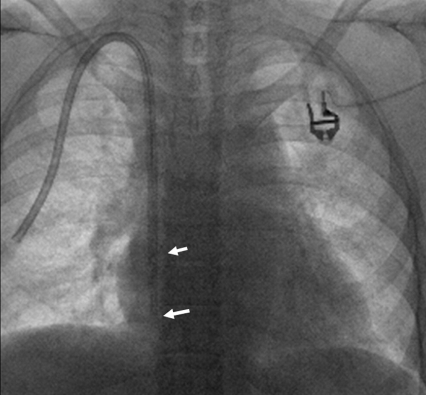 Disrupting Catheter Associated Fibrin Sheath Formation - Renal Fellow ...