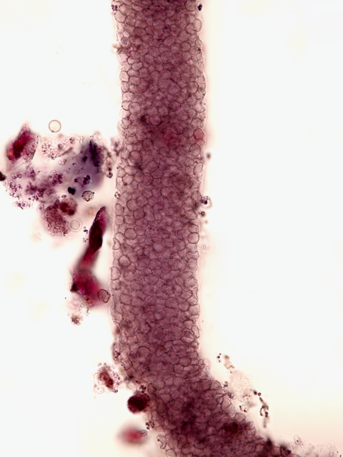 Urine Sediment of the Month Archives - Renal Fellow Network