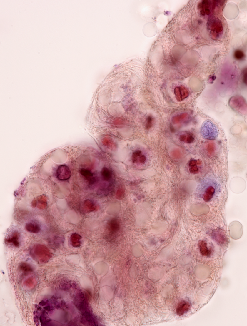 Urine Sediment of the Month: Fibrin Casts in Urine Microscopy - Renal ...