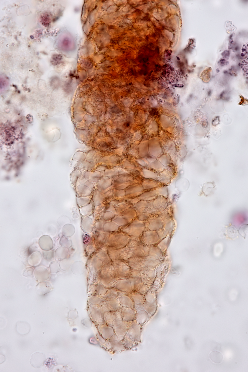 Urine Sediment of the Month: Fibrin Casts in Urine Microscopy - Renal ...