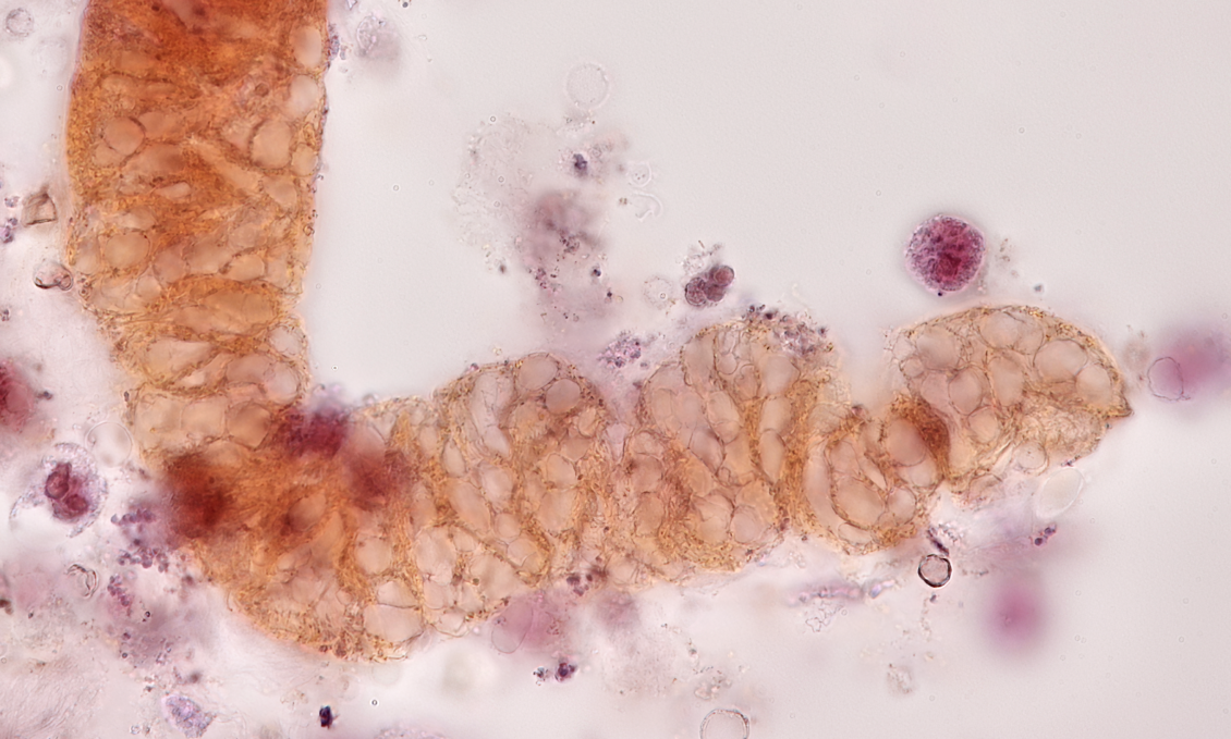 Urine Sediment of the Month: Fibrin Casts in Urine Microscopy - Renal ...