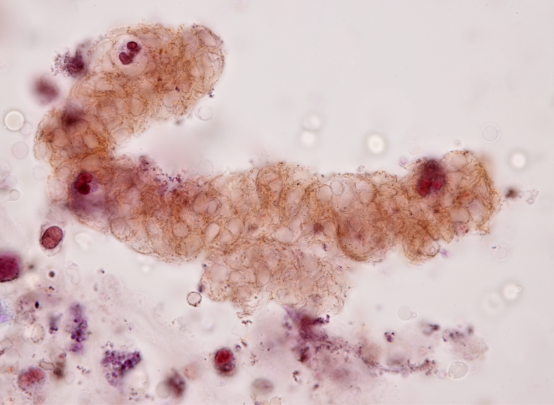 Urine Sediment of the Month: Fibrin Casts in Urine Microscopy - Renal ...