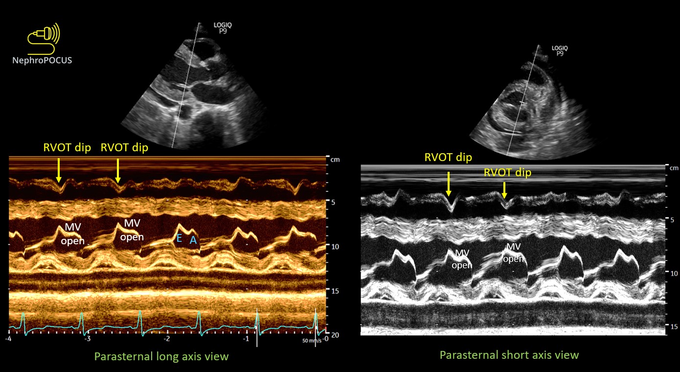 Pericardial effusion detected on point of care ultrasound: What next ...