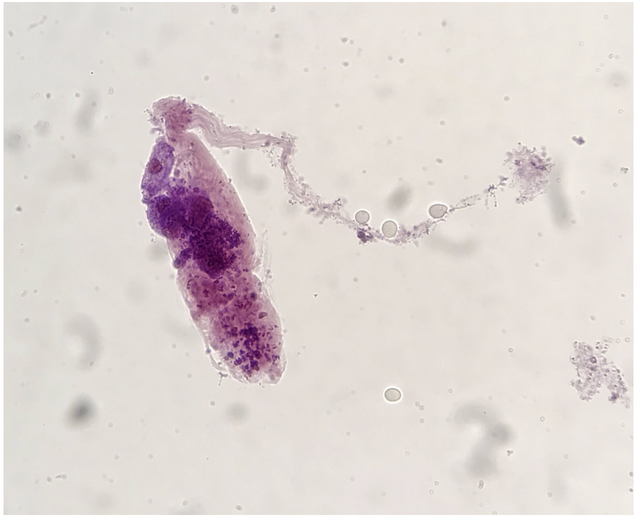 Urine Sediment Of The Month Urinal Sediment Microscopy 240+ Urine