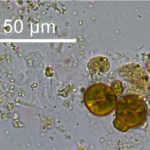 Leucine Crystals in the Urine – Still enigmatic after more than 150 ...