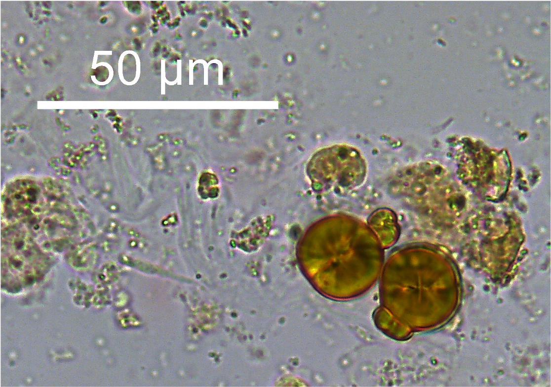 Leucine Crystals in the Urine – Still enigmatic after more than 150 ...