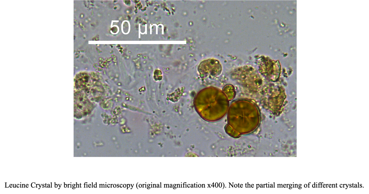 Leucine Crystals in the Urine – Still enigmatic after more than 150 ...