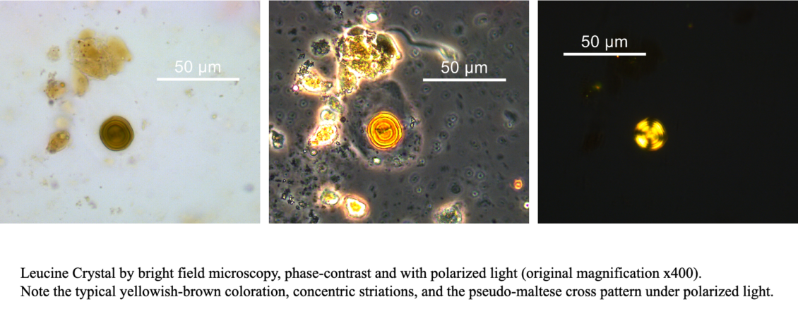 Leucine Crystals in the Urine – Still enigmatic after more than 150 ...