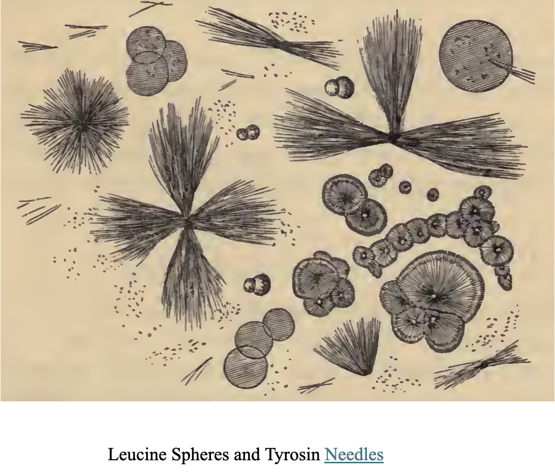 Leucine Crystals in the Urine – Still enigmatic after more than 150 years - Renal Fellow Network