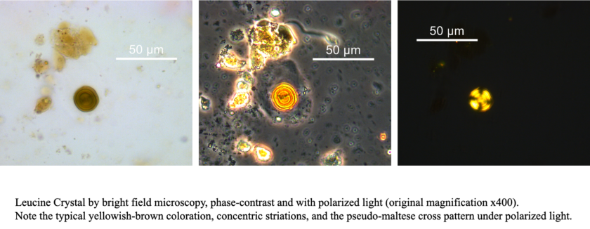Leucine Crystals in the Urine – Still enigmatic after more than 150 ...