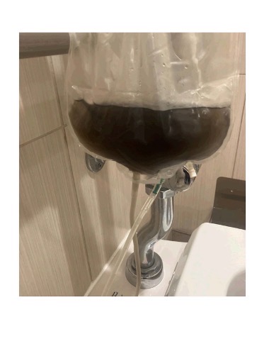 The Different Colors of Peritoneal Dialysate - Renal Fellow Network